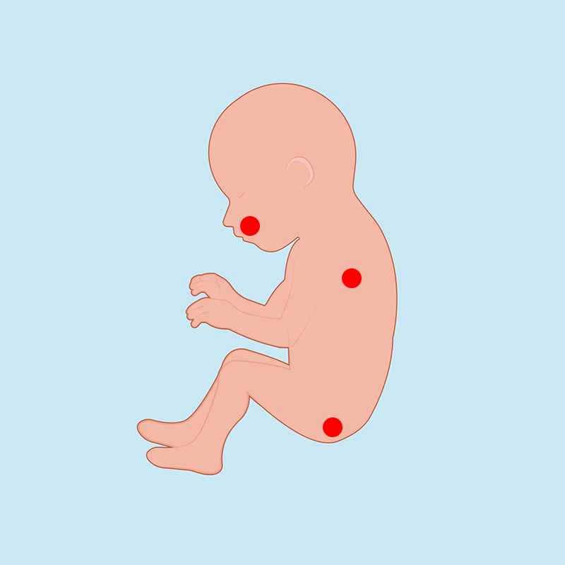 Fetal Surgery – Neofetal México